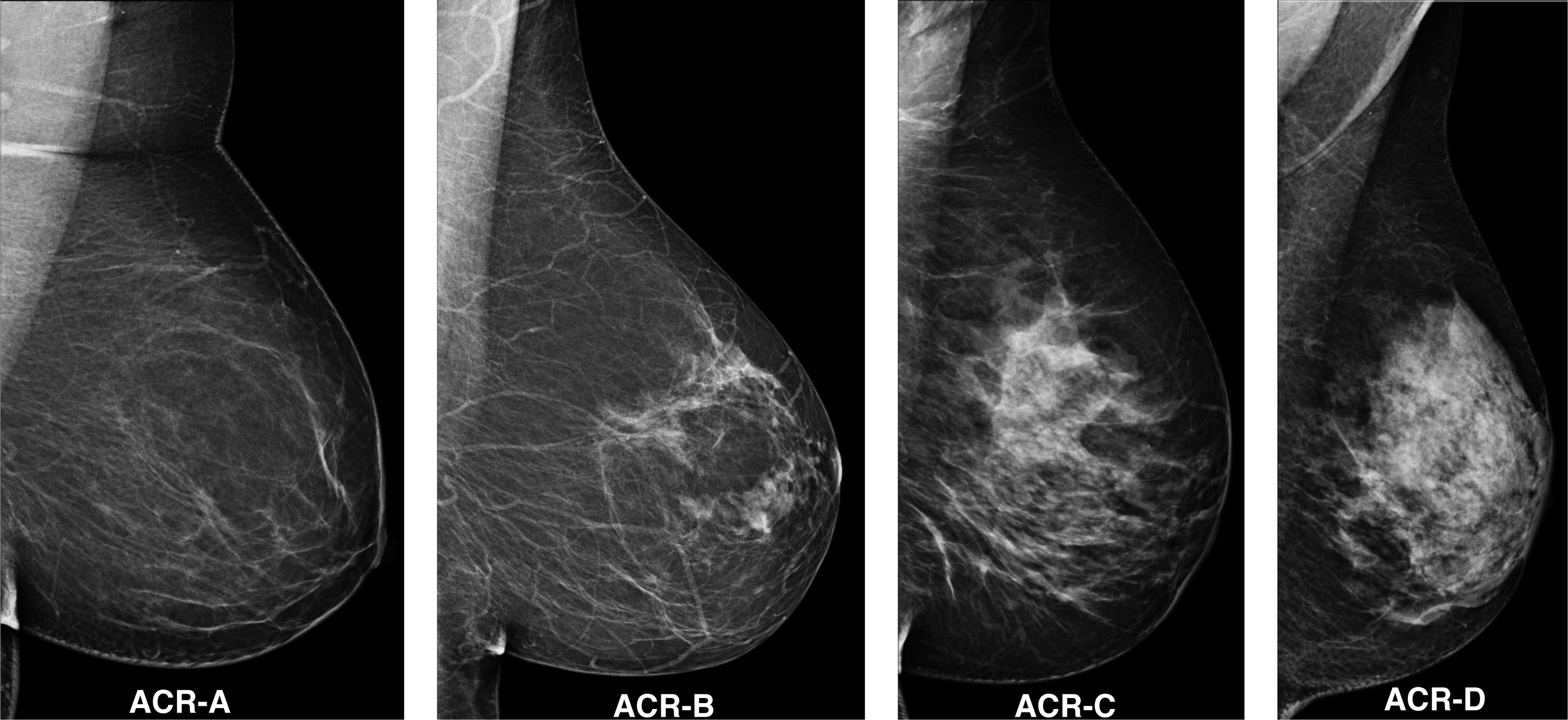 Association of high breast density with adverse effects of the breast ...