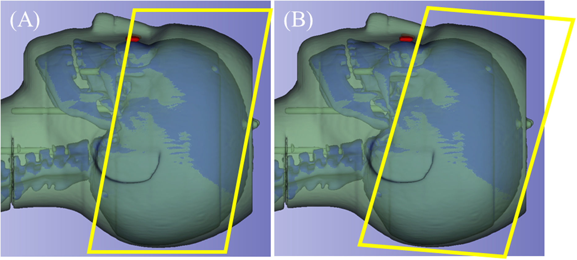 Usefulness of the superior orbitomeatal line without the lens included ...