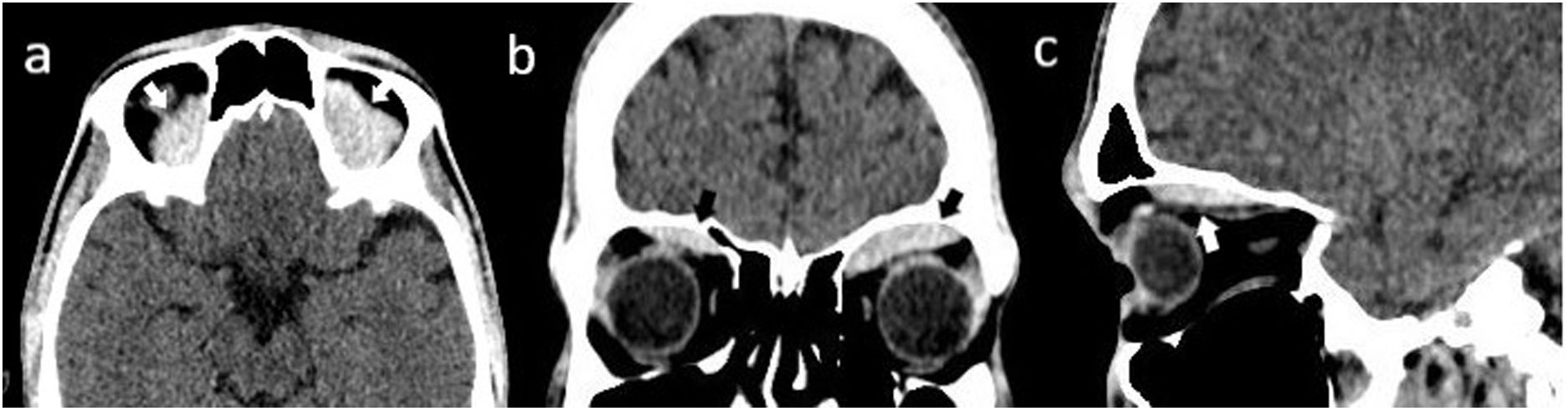 Complicated migraine: Importance of neuroimaging | Radiología (English ...
