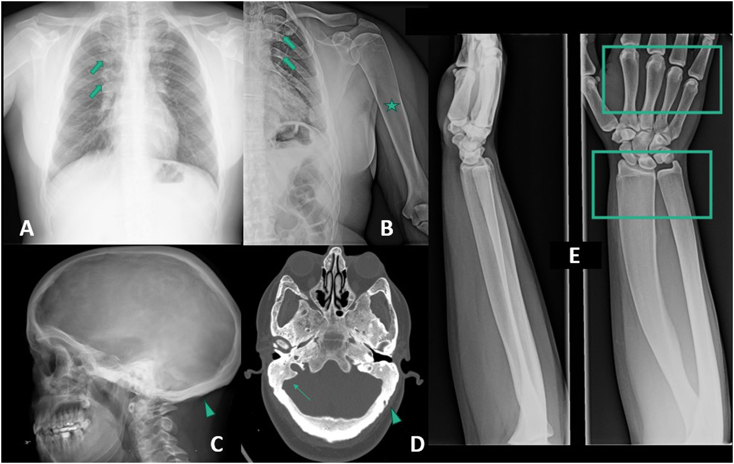 Bone fracture after minor trauma in Pyle’s disease: A rare case in an ...