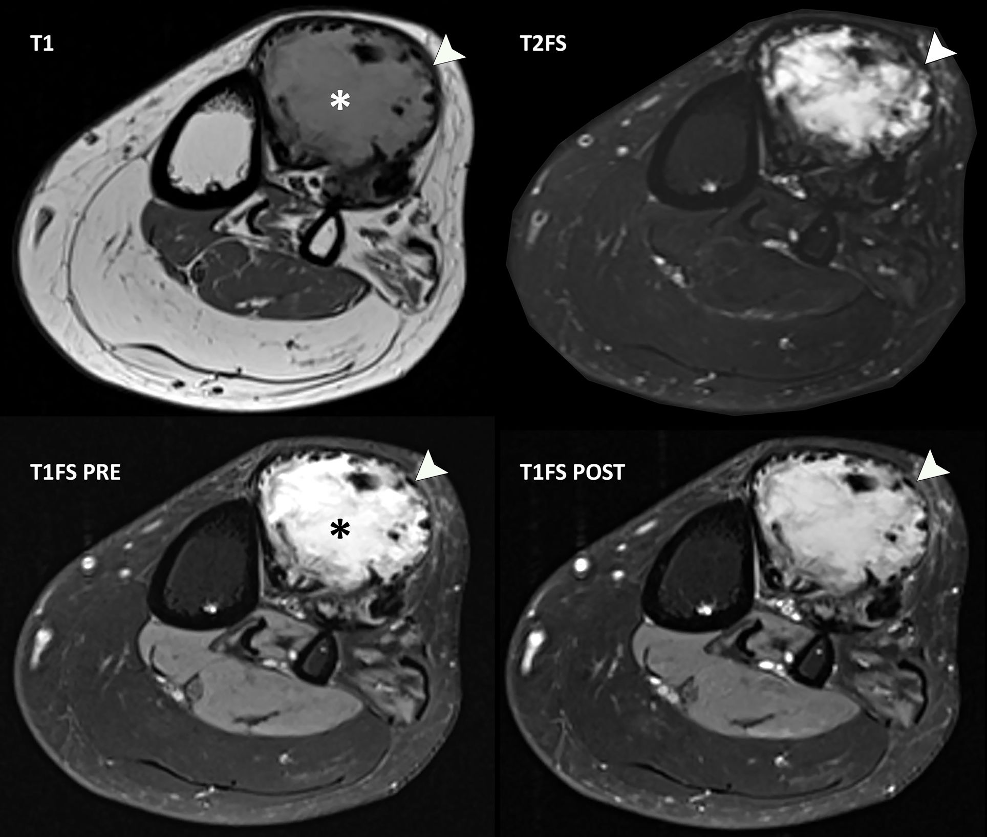 Calcific myonecrosis: An aggressive lesion simulator | Radiología ...
