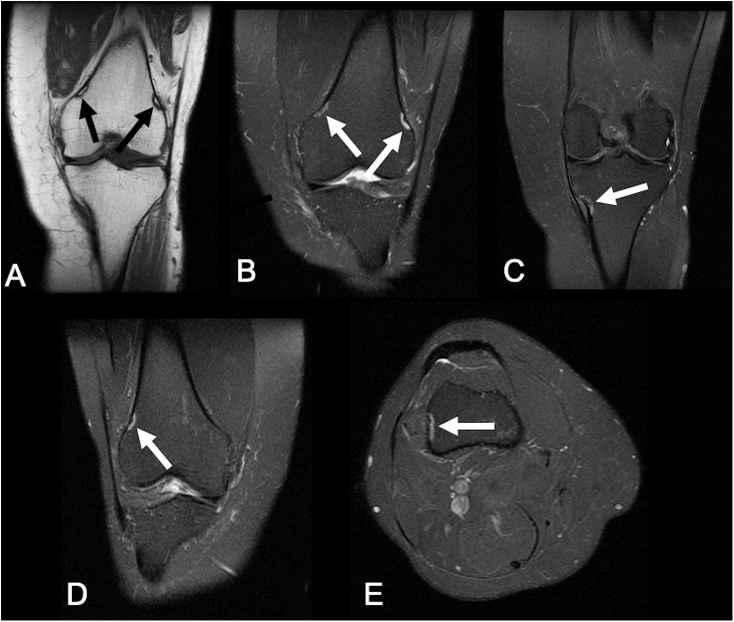 Magnetic resonance imaging features of focal bone lesions secondary to ...