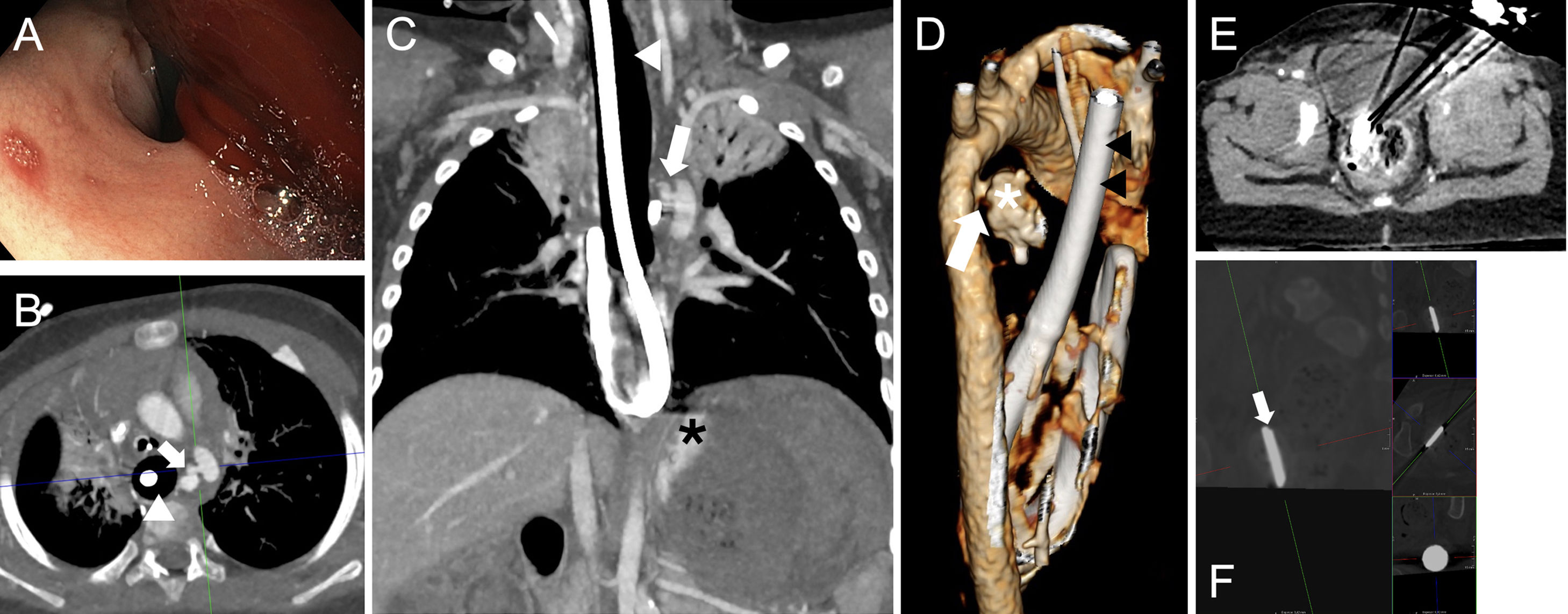 The use of imaging tests in paediatric button battery ingestion ...