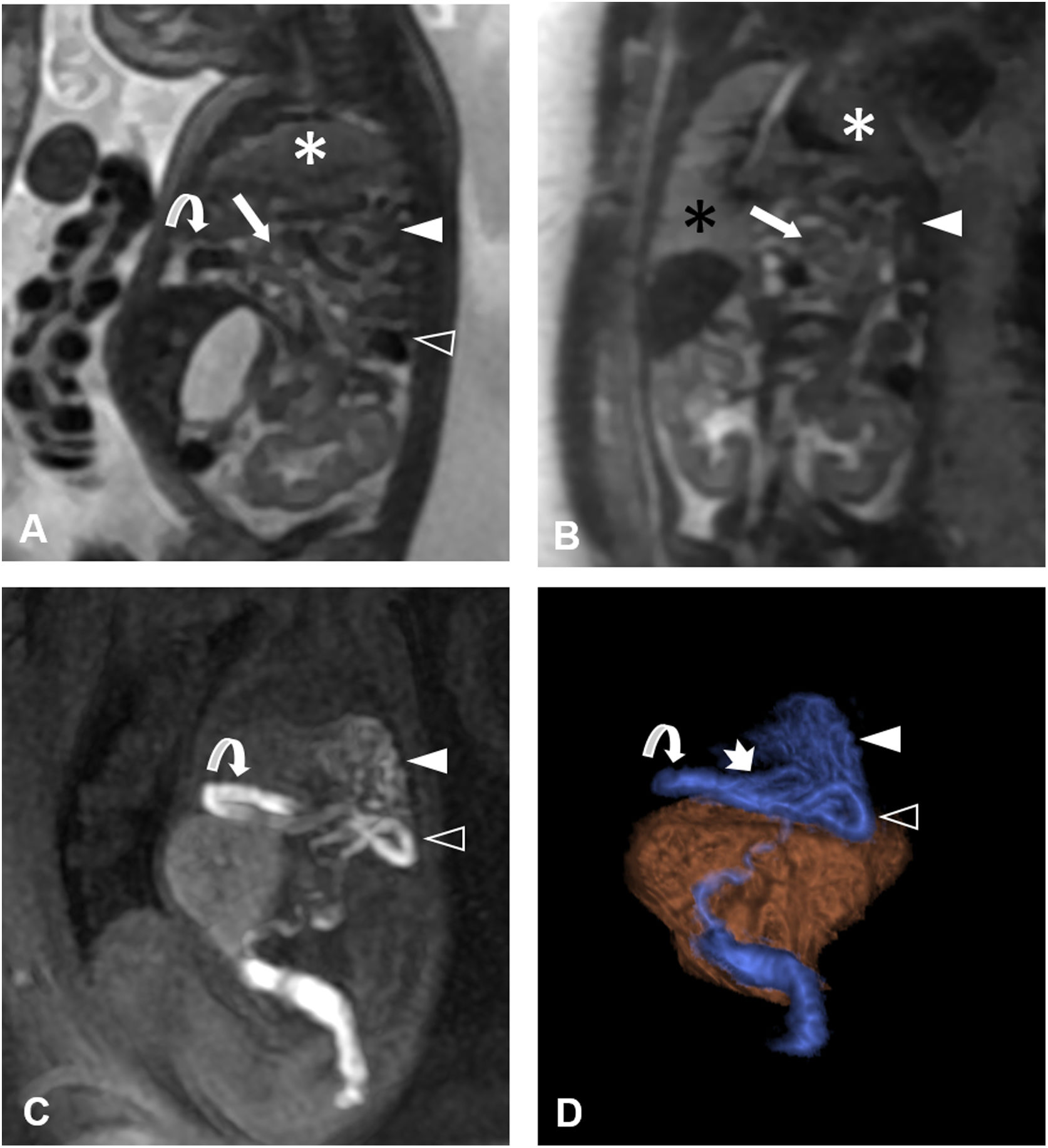 Foetal MRI for cardiovascular and thoracic diseases | Radiología ...