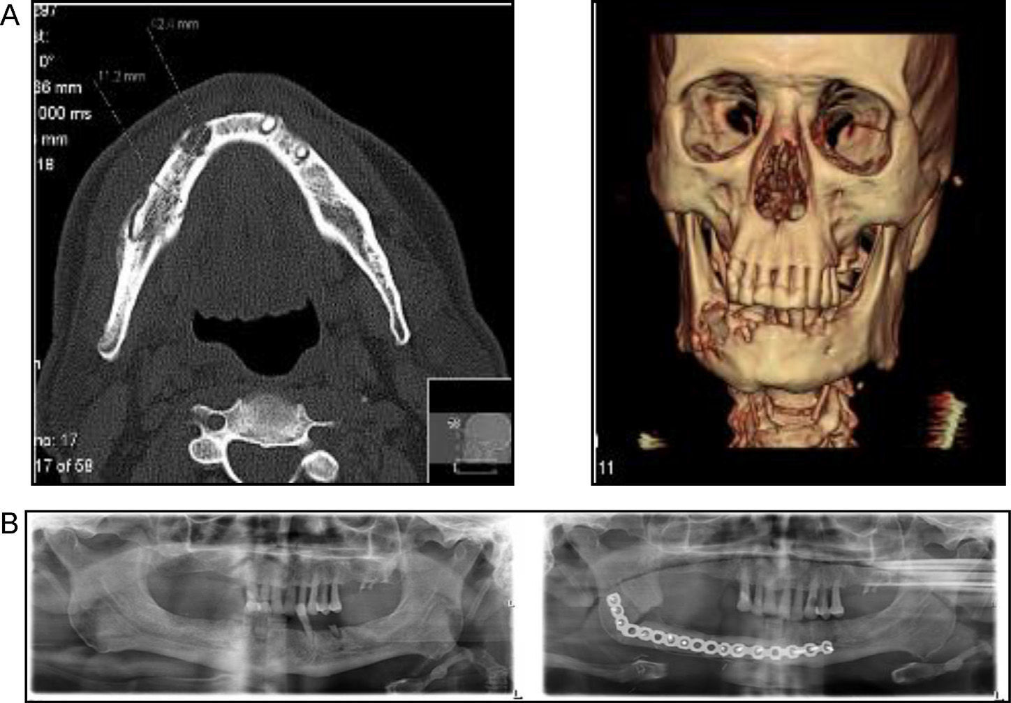 osteoradionecrosis ct
