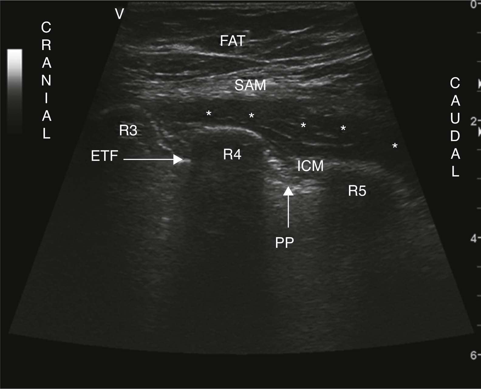 A new thoracic interfascial plane block as anesthesia for difficult ...