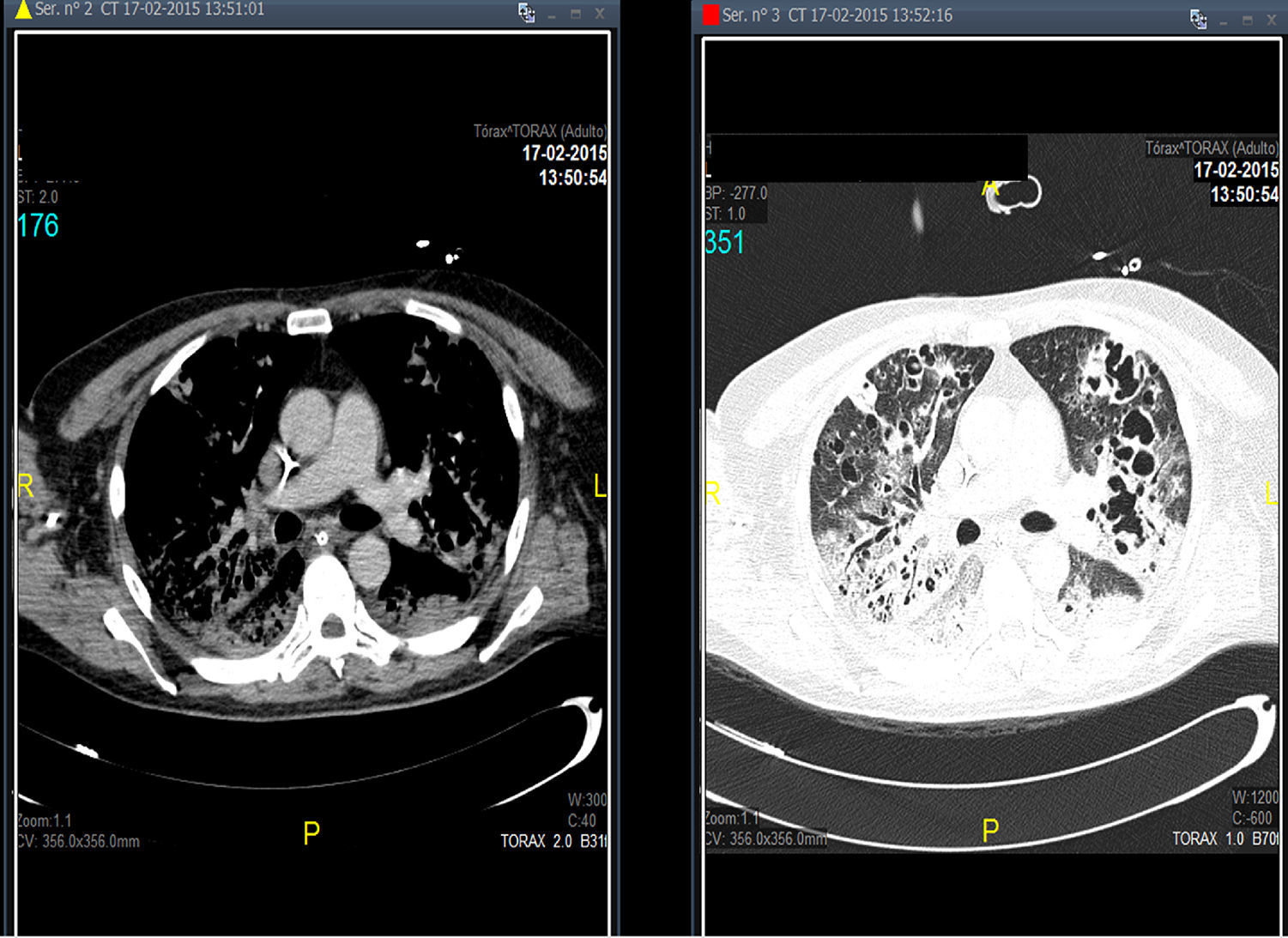 Successful treatment of Panton–Valentine leukocidin-positive ...