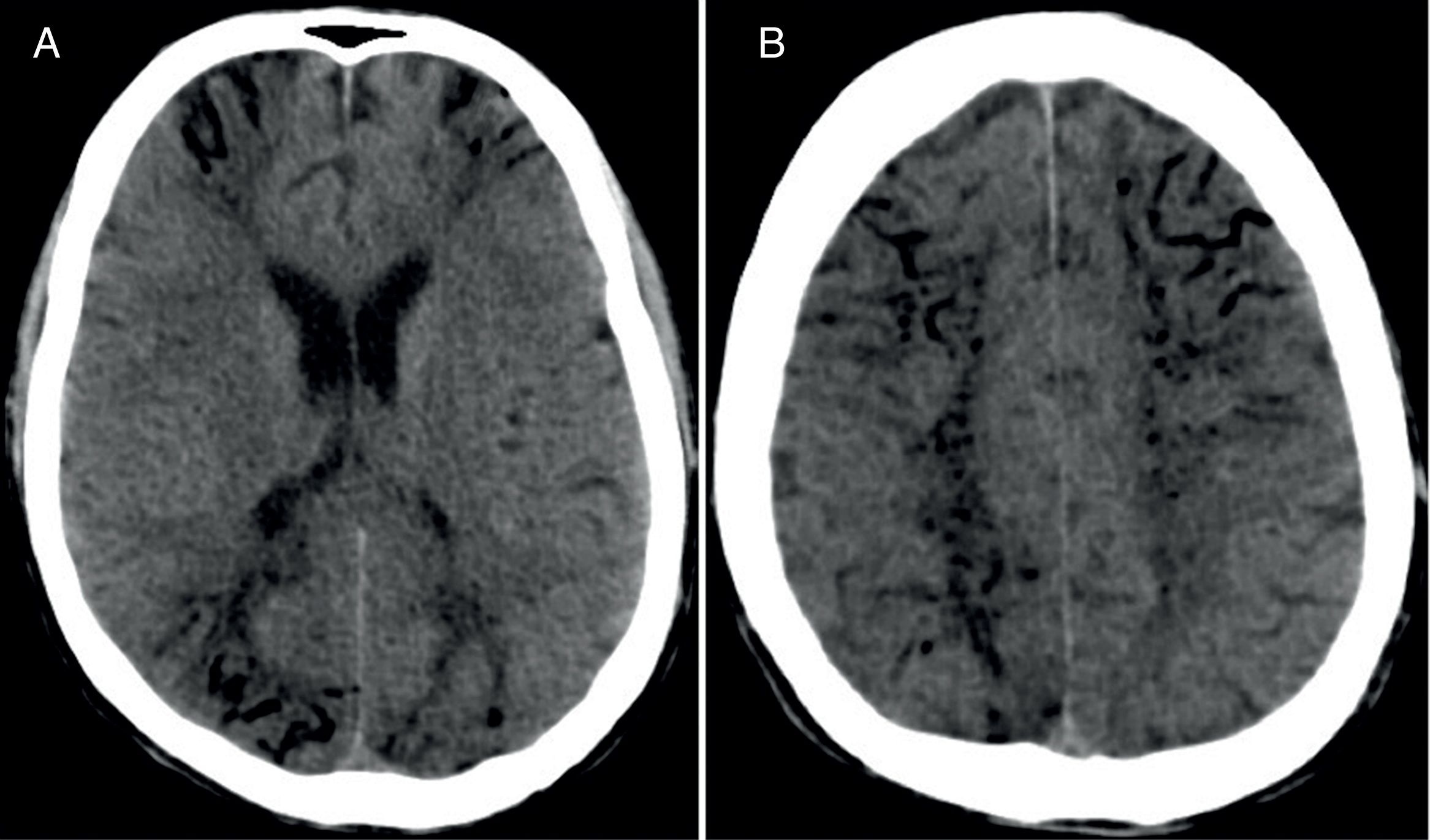 Delayed massive cerebral fat embolism secondary to severe polytrauma ...