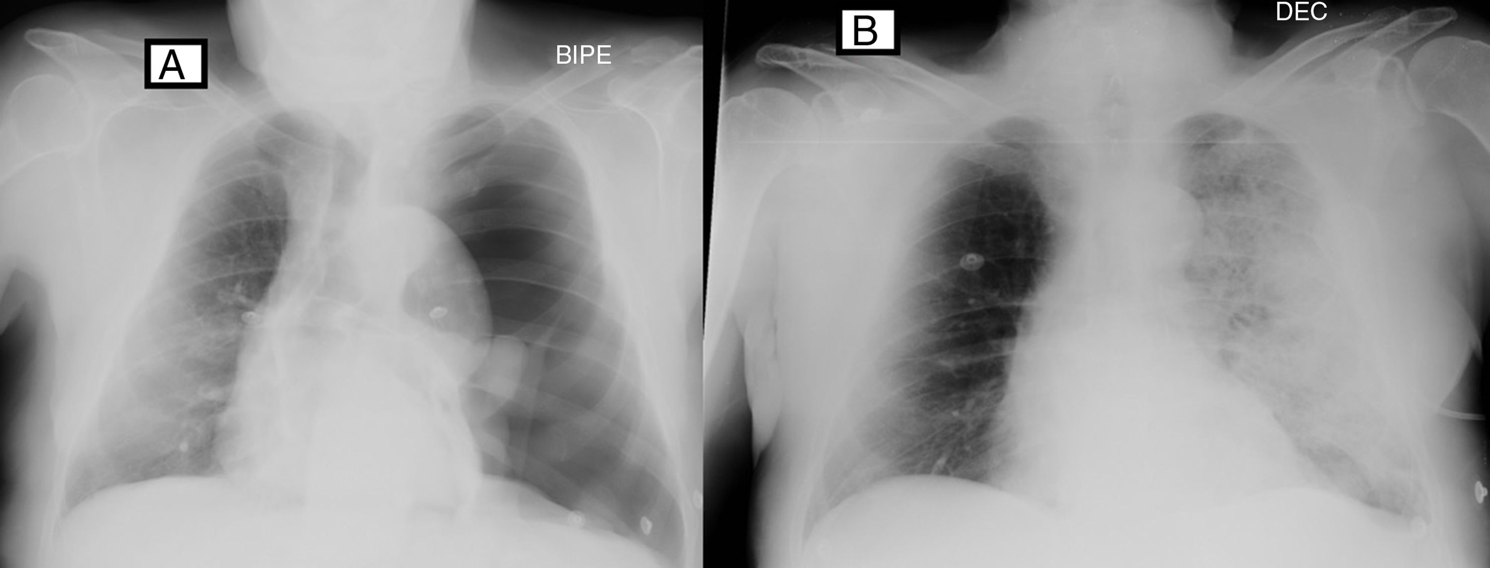 Pulmonary edema ex vacuo after drainage of pneumothorax | Medicina ...