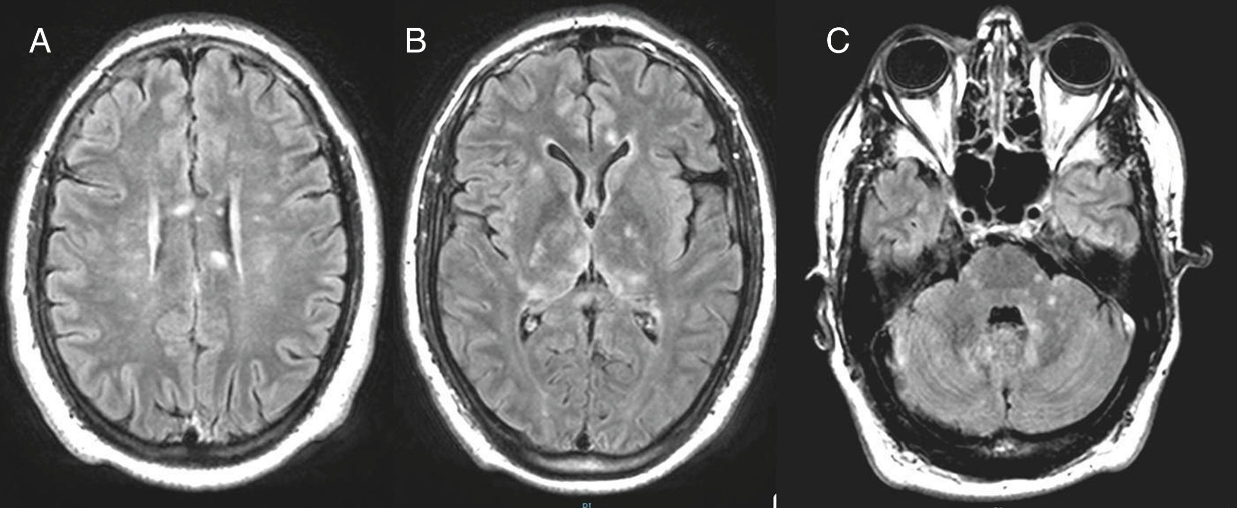 Susac's syndrome. A case of autoimmune encephalitis | Medicina Intensiva