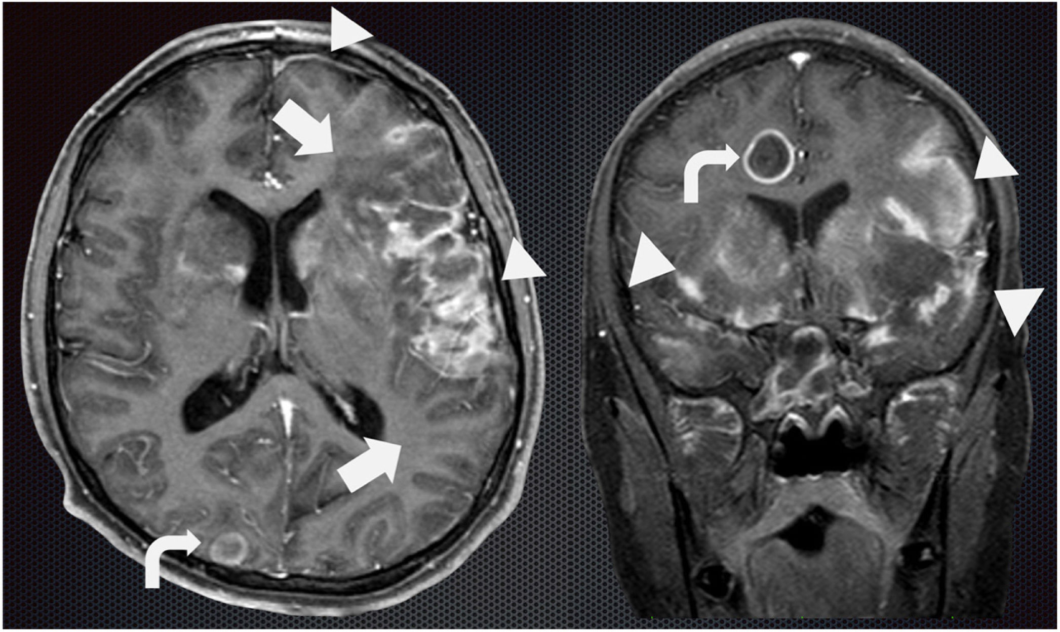 Complications of tuberculous meningitis in magnetic resonance imaging ...