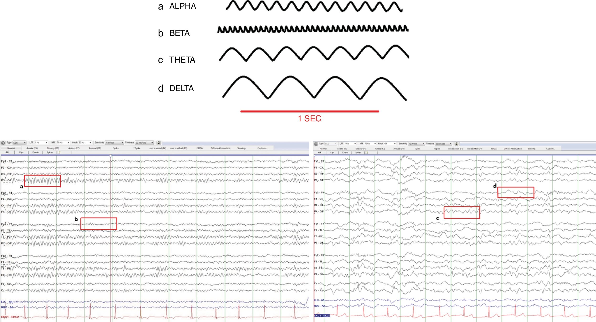 normal eeg waves