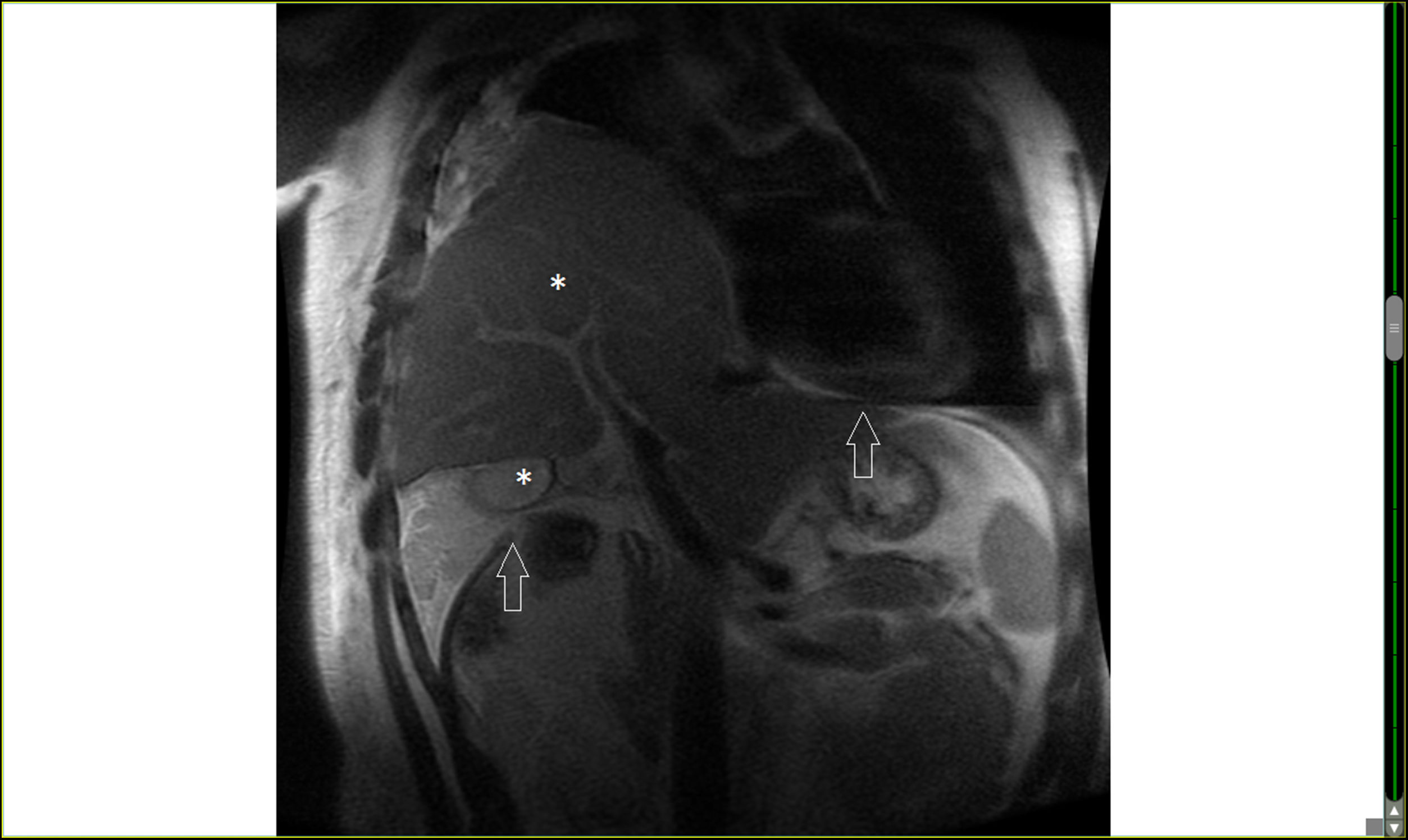 Post-traumatic diaphragmatic rupture | Medicina Intensiva