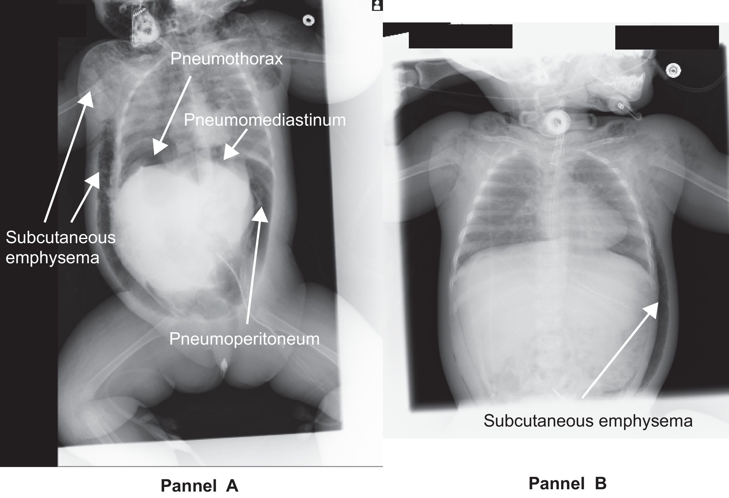 A pediatric case of severe systemic pneumatosis during airway pressure ...
