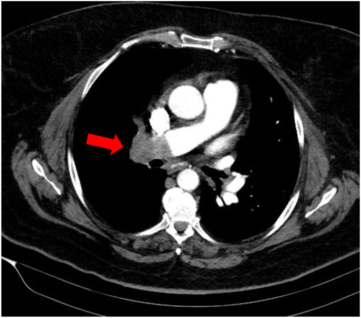 Diagnosis of pulmonary infarction by chest ultrasound in patient with ...