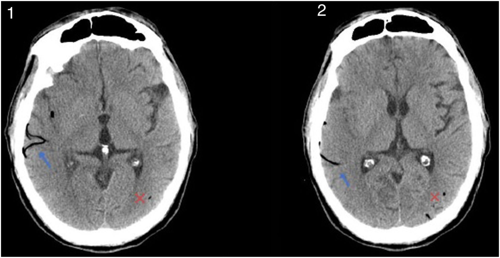 Gas embolism following extracorporeal circulation | Medicina Intensiva