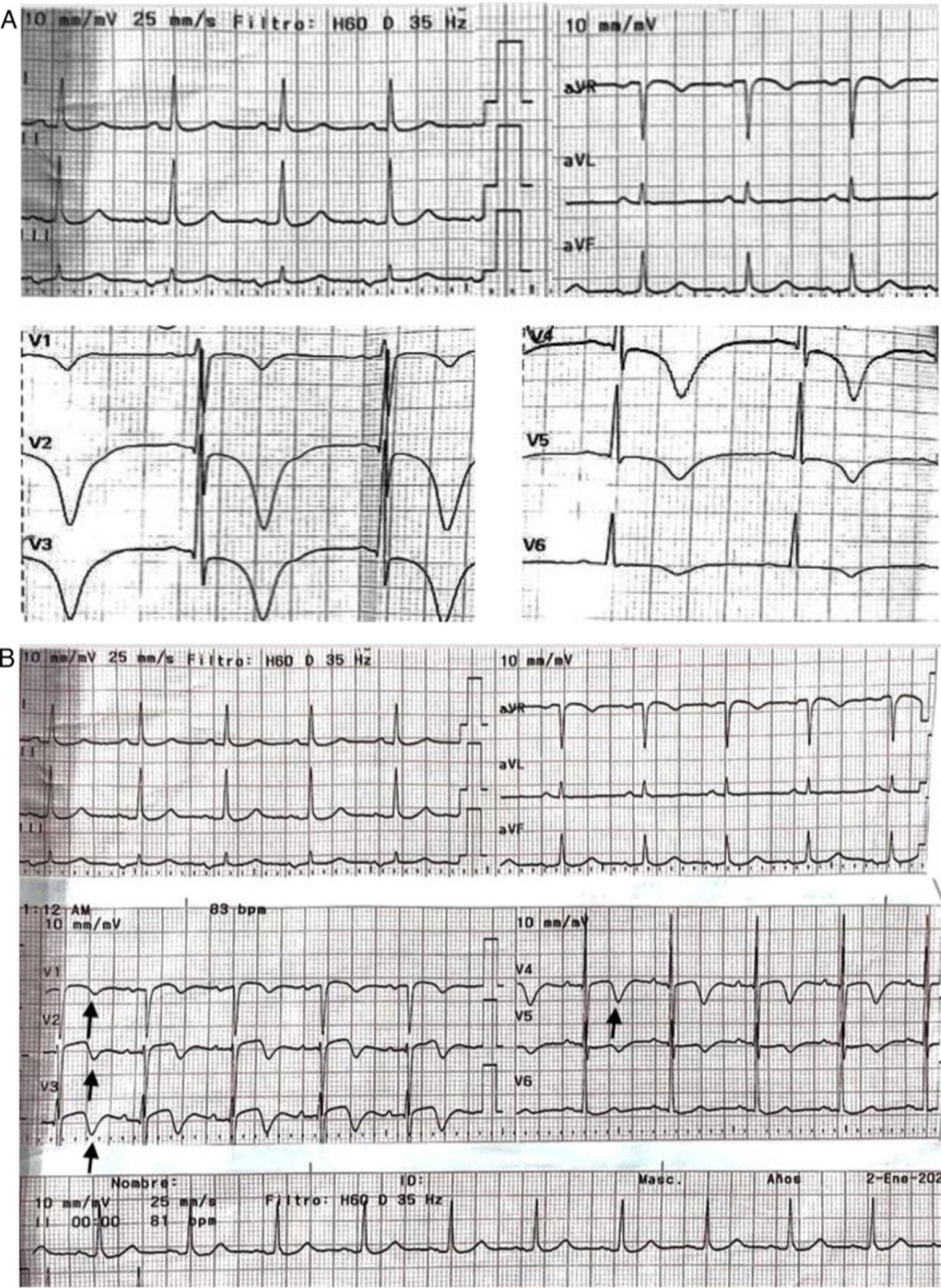 Wellens Syndrome: Be aware of T wave inversion | Medicina Intensiva