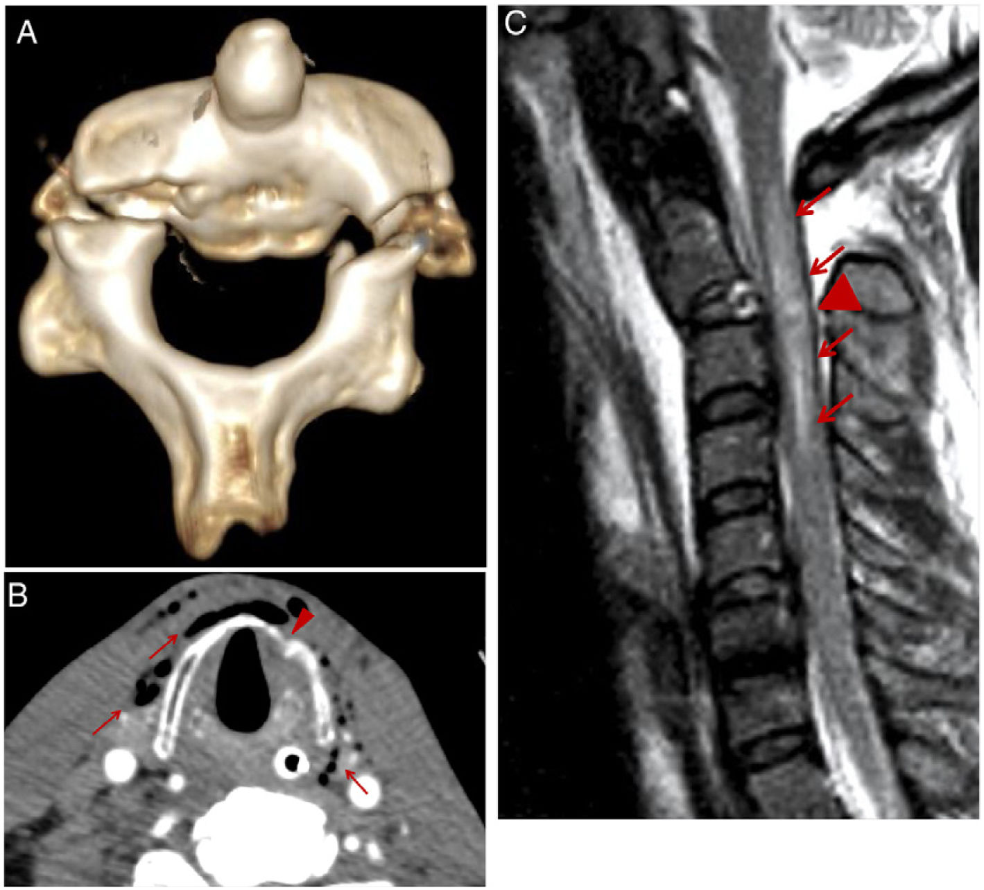 Traumatic cervical injuries secondary to attempted suicide by hanging ...