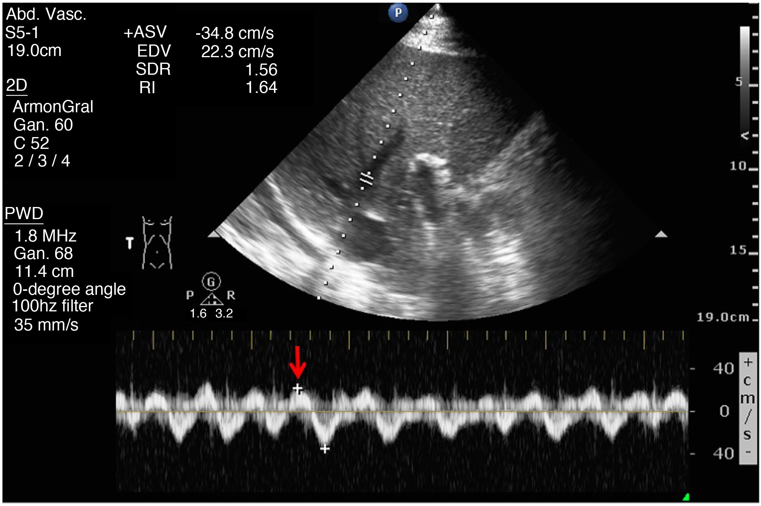 VExUS: Severe systemic congestion with normal portal flow | Medicina ...