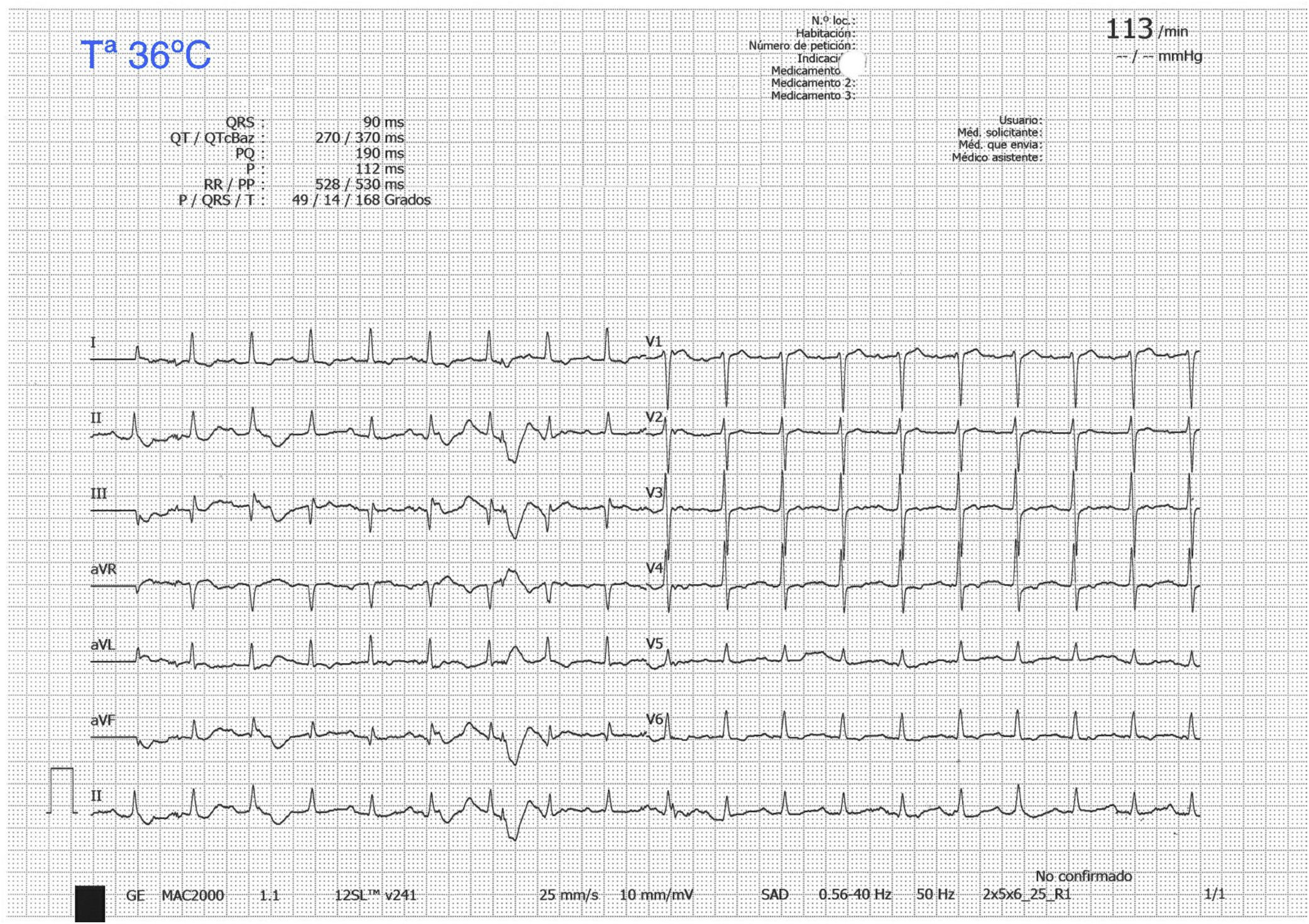 Evolution of Osborn’s J-wave in severe hypothermia | Medicina Intensiva