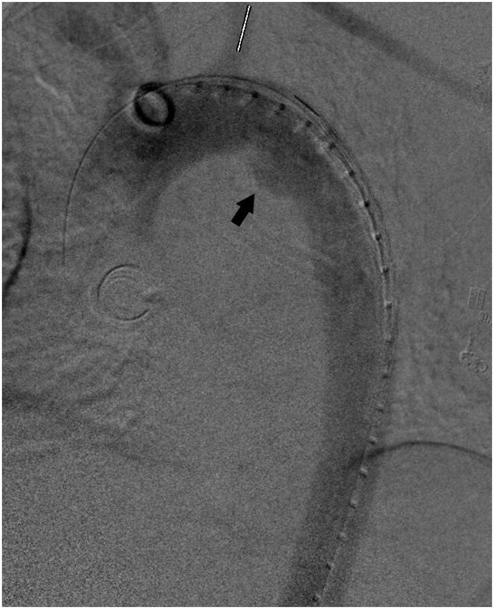 Right diaphragmatic rupture associated with aortic dissection after ...