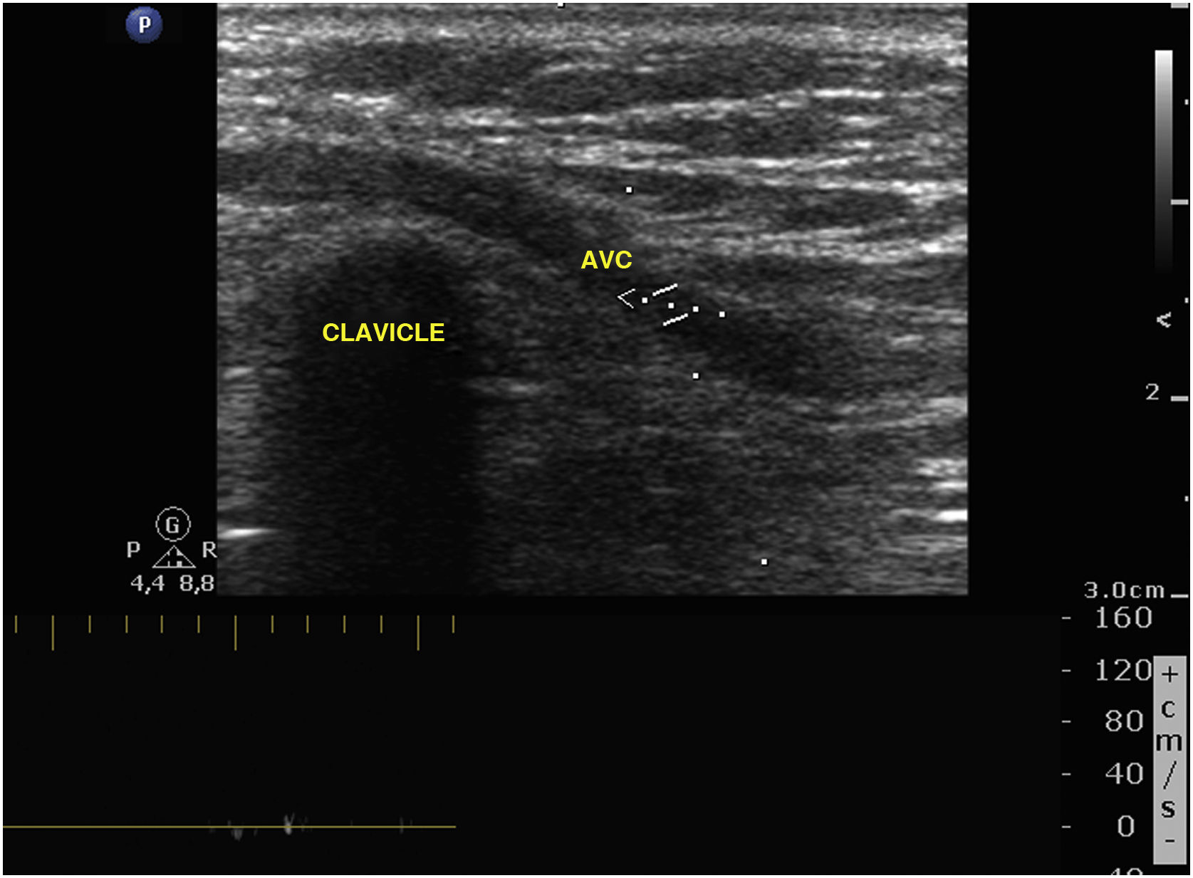 Catheter-related venous thrombosis: Simultaneous occlusion of cephalic ...