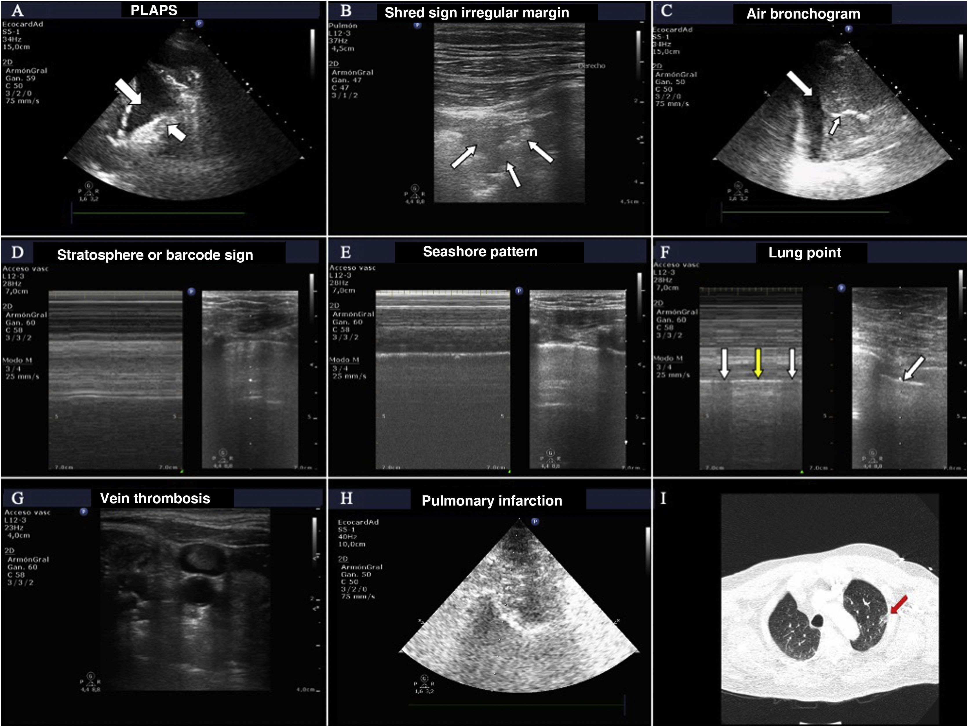 Role of ultrasound in acute respiratory failure and in the weaning of ...