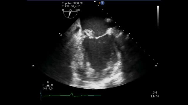Multiple fistulization and atrioventricular block in a patient with ...
