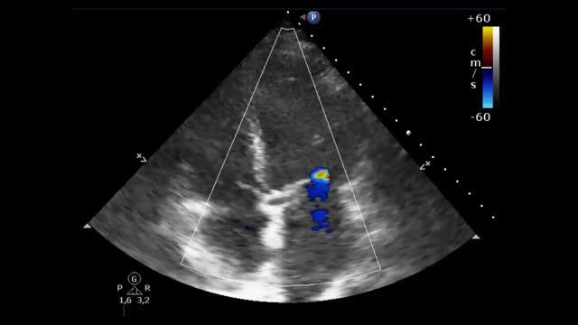 Multiple fistulization and atrioventricular block in a patient with ...