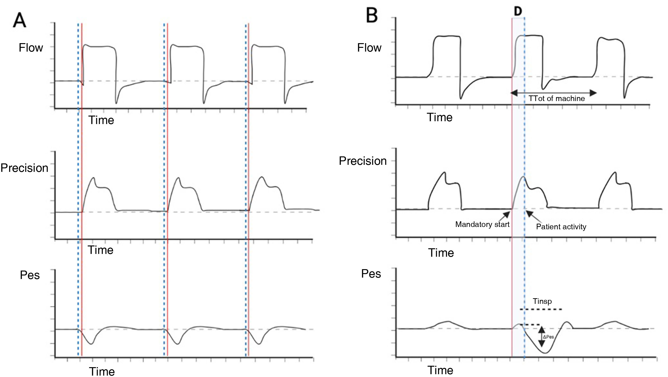 abnormal ventilator waveforms