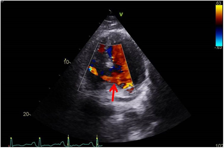 Diagnosis of interventricular septum rupture by means of computed axial ...