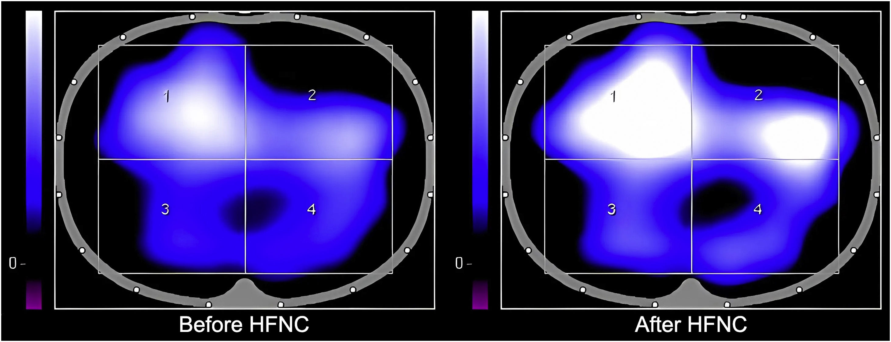High-flow oxygen therapy in single lung transplant for COPD | Medicina ...