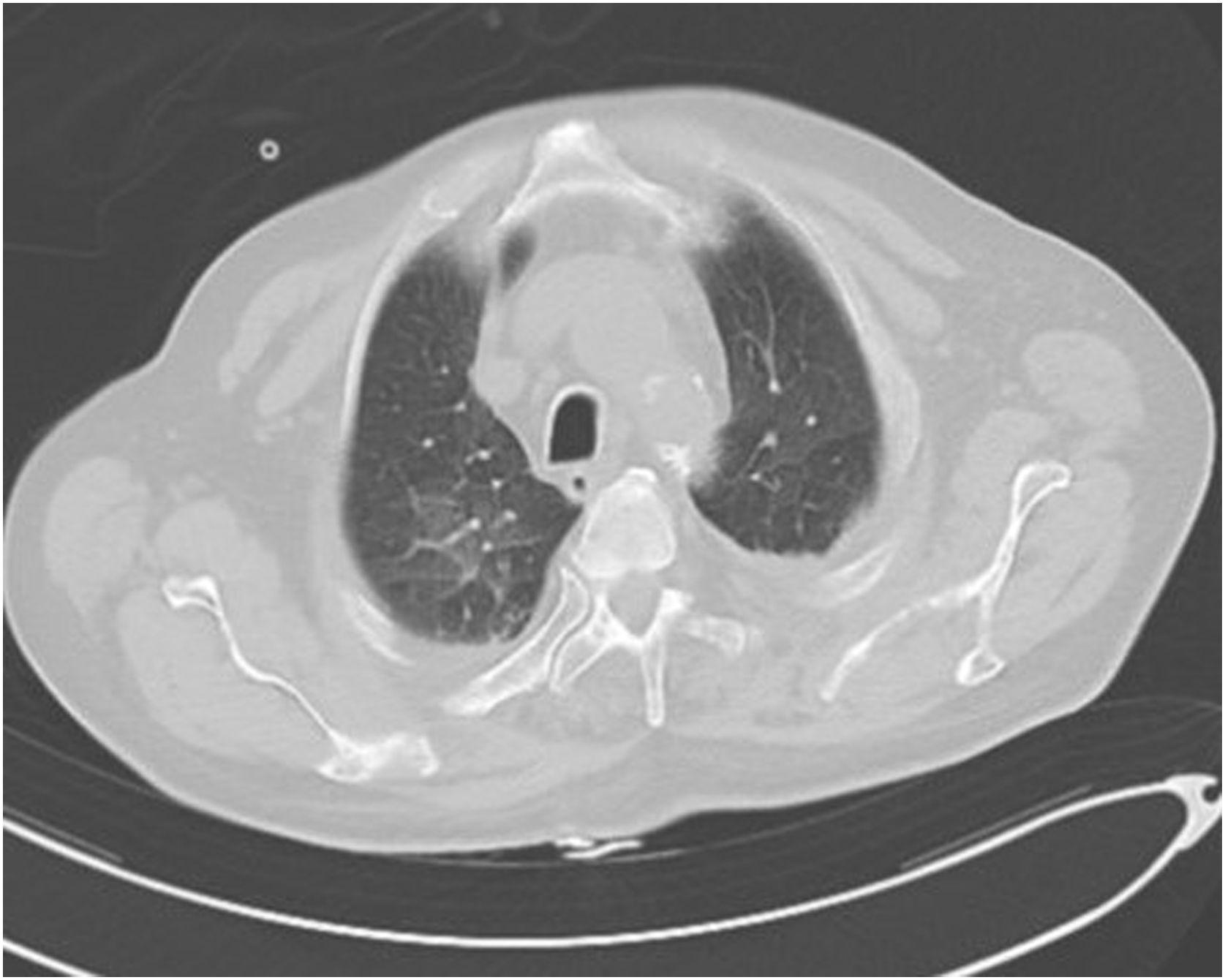 McConnell’s sign in fat embolism syndrome | Medicina Intensiva