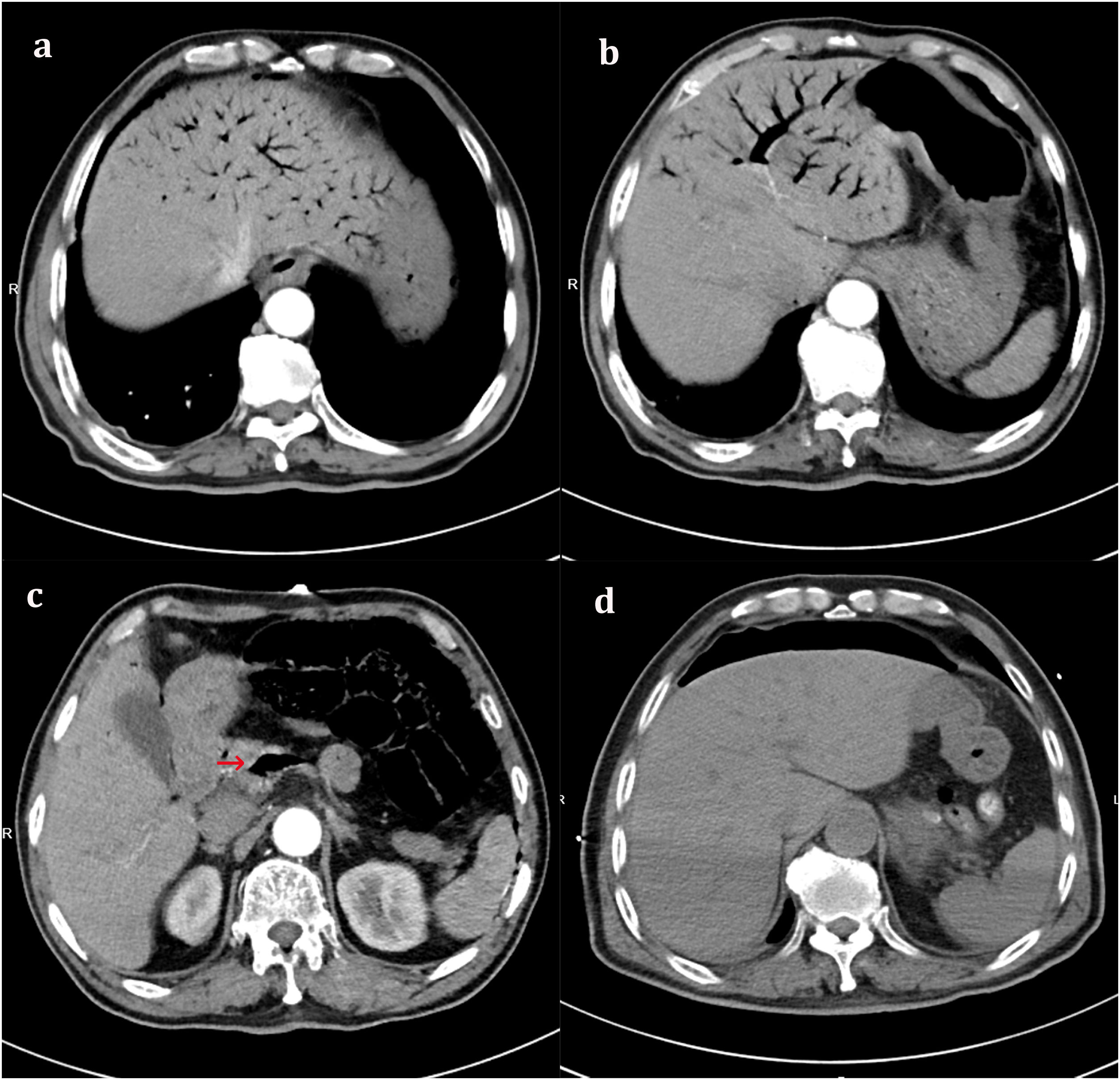 Ultrasound artifacts “shred sign” and “pseudo-B lines” in the liver ...