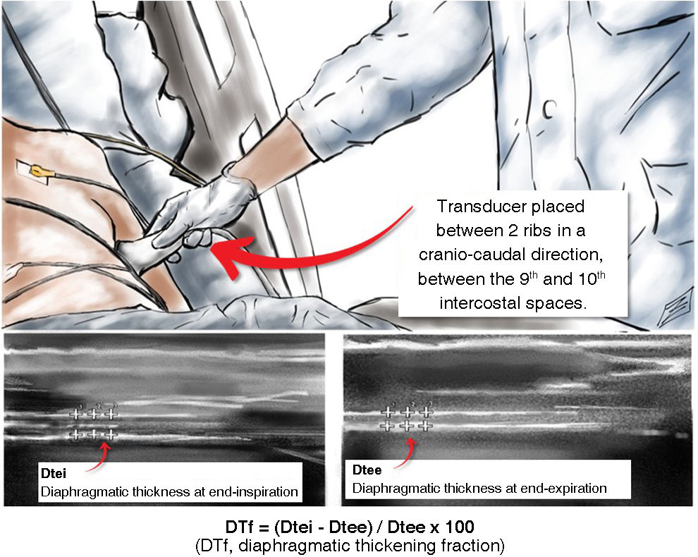 Impact of high-flow oxygen therapy via high velocity nasal insufflation ...