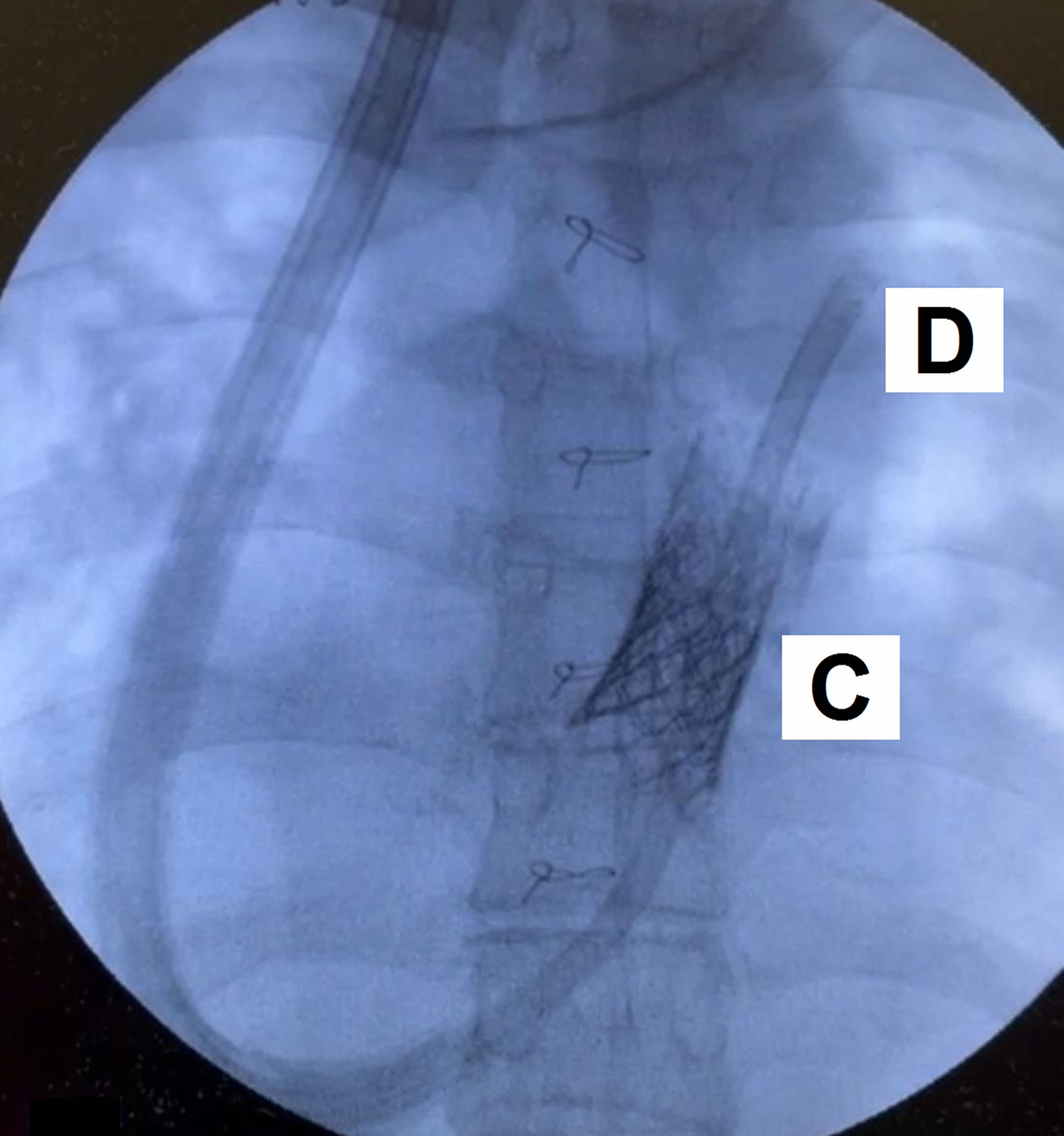 ProtekDuo cannula through Melody transcatheter pulmonary valve ...