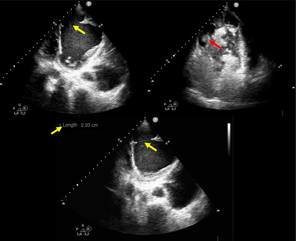 Cardiogenic shock due to a large apical pseudoaneurysm of the left ...