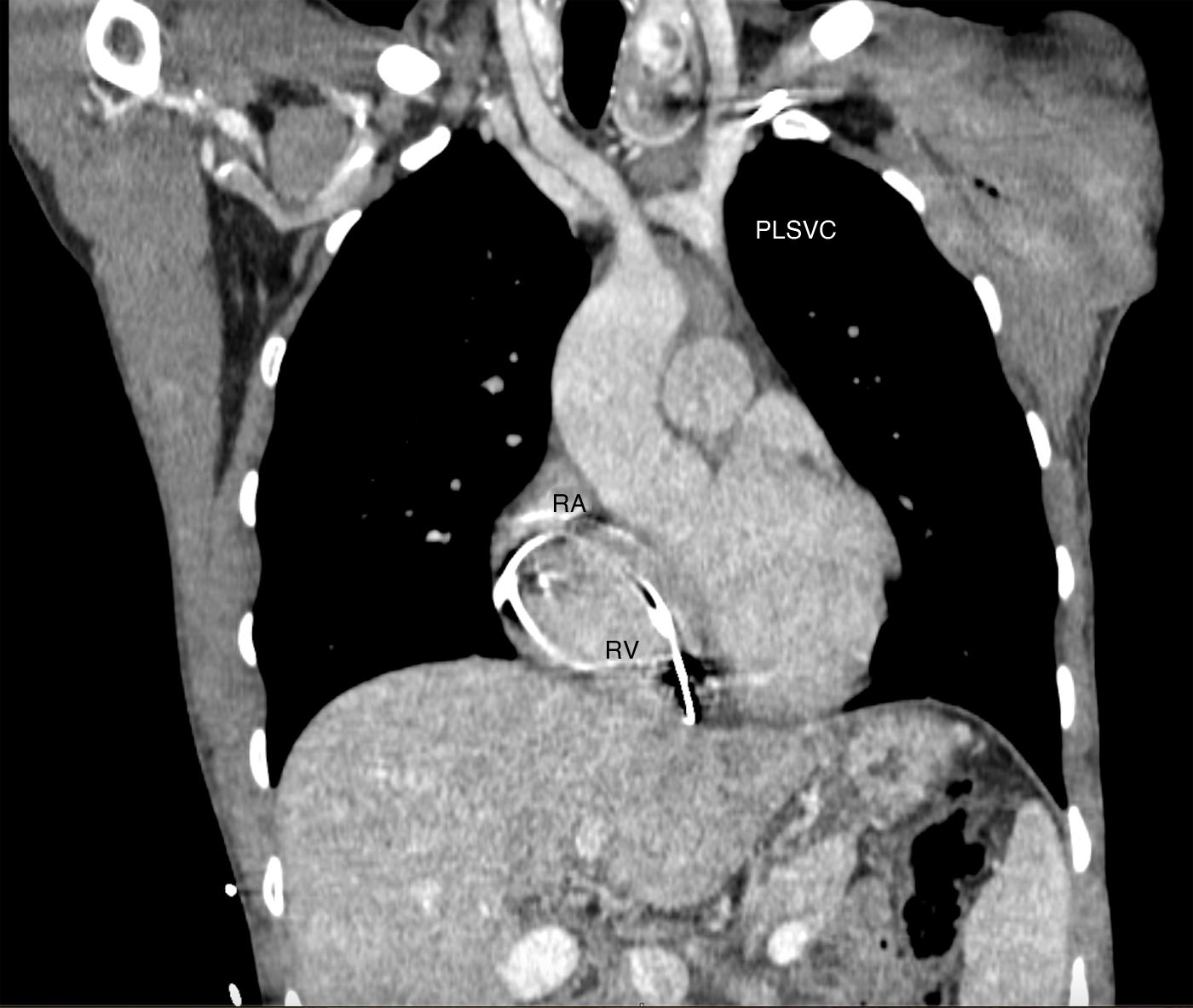 Persistent left superior vena cava finding during pacemaker ...