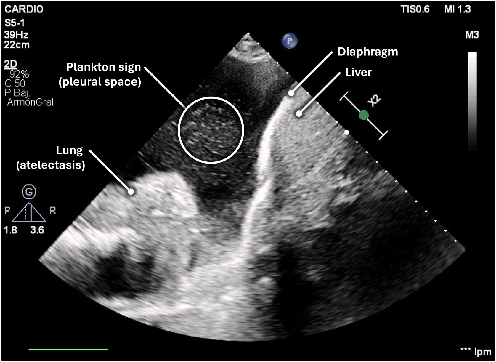 Nutrithorax: an uncommon differential diagnosis of the plankton sign ...