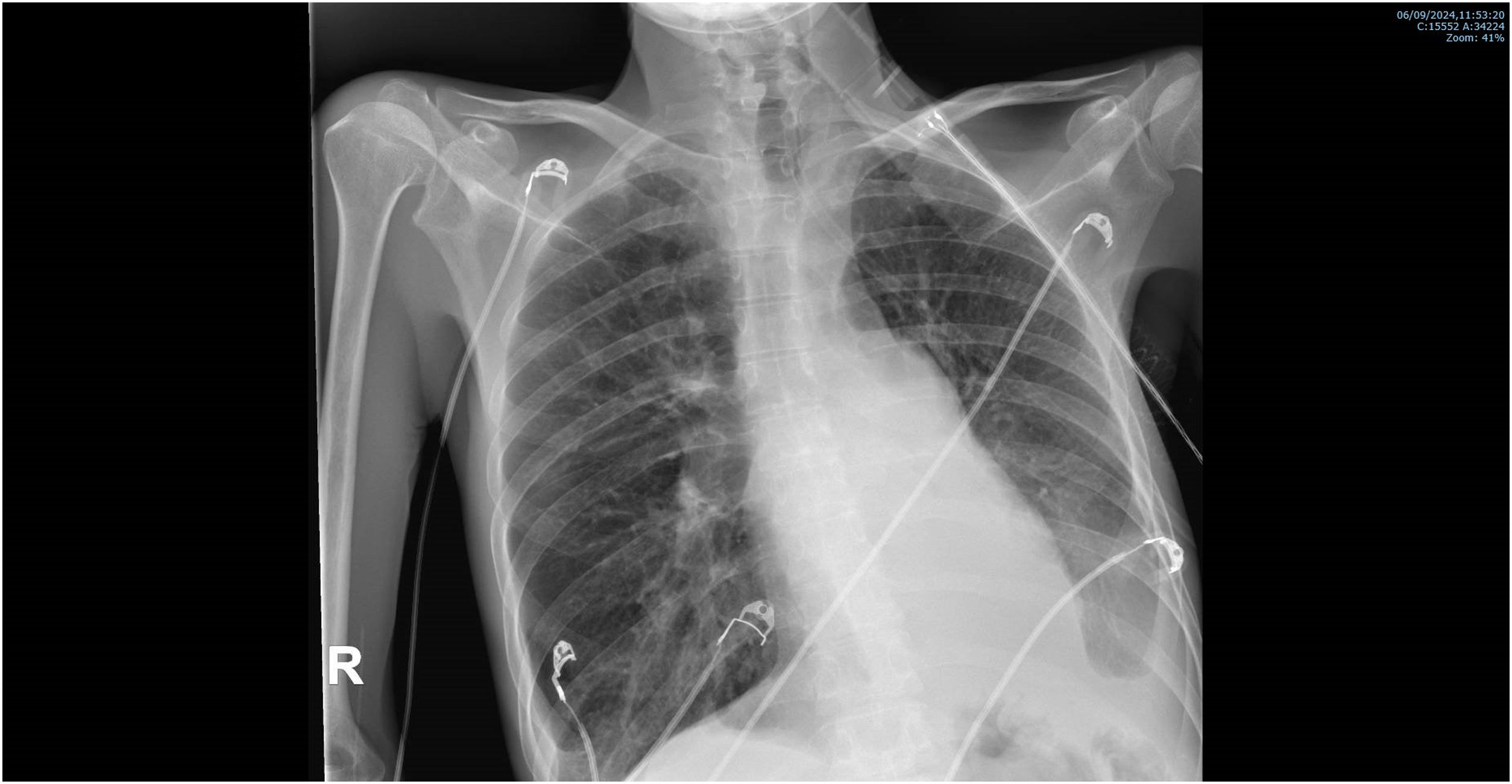 Effect of respiratory physiotherapy in a patient with complete ...