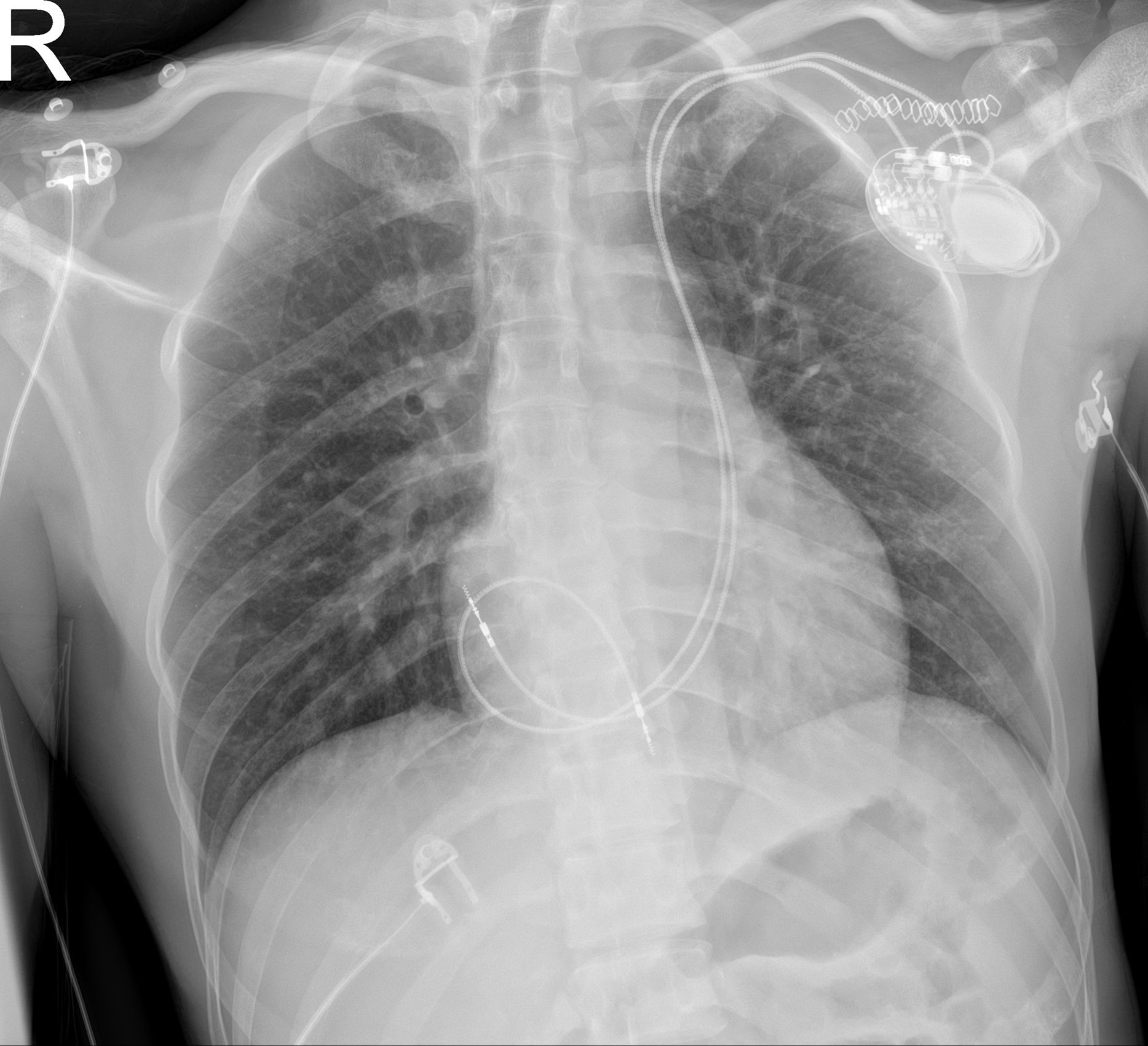 Persistent left superior vena cava finding during pacemaker ...