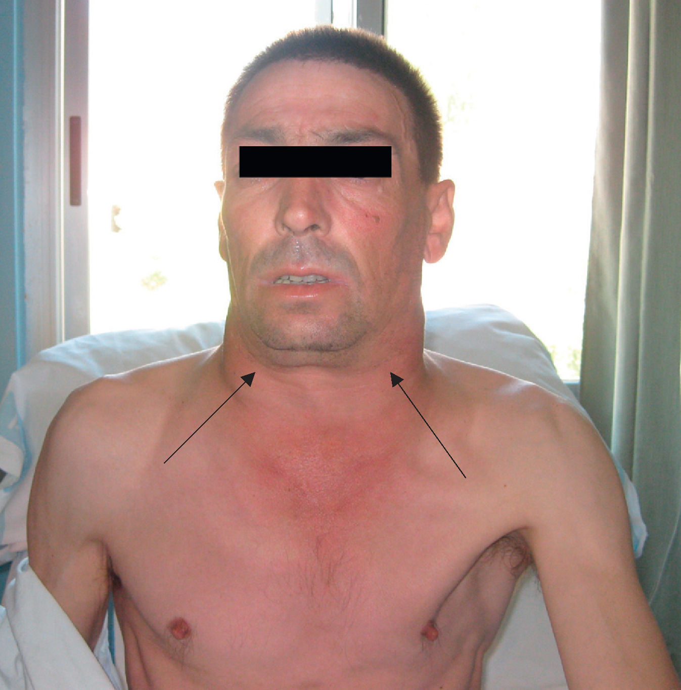 Cervical Emphysema and Spontaneous Pneumomediastinum: Infrequent ...