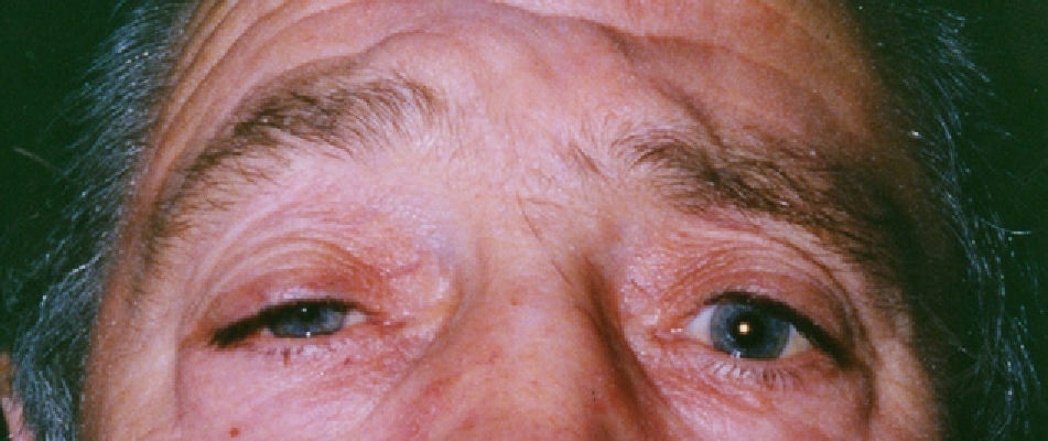 Horner's Syndrome After Neck Surgery | Acta Otorrinolaringológica Española