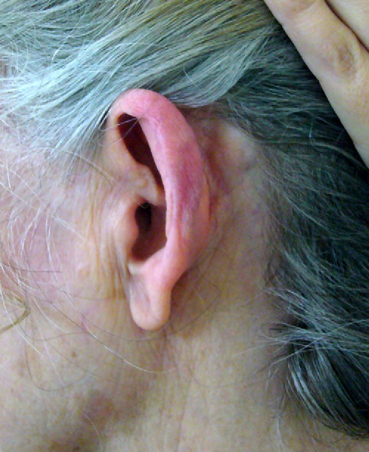 Retroauricular Arteriovenous Fistula | Acta Otorrinolaringológica Española