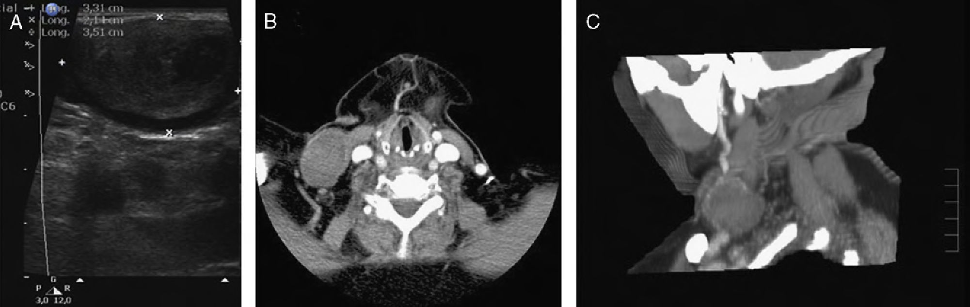 Thrombosed Phlebectasia of the External Jugular Vein With Neck Pain ...