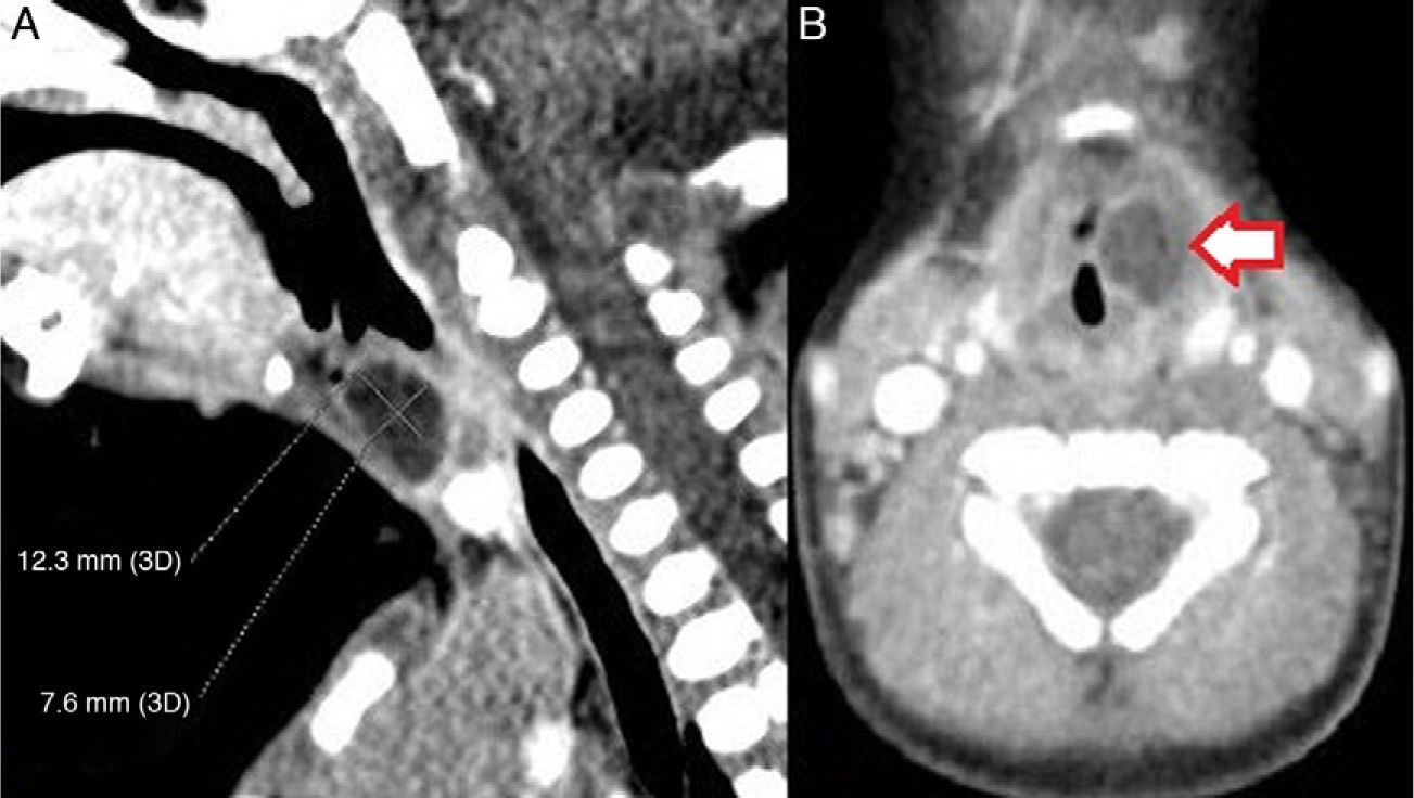 Congenital Saccular Cyst of the Larynx: A Rare Cause of Stridor in ...