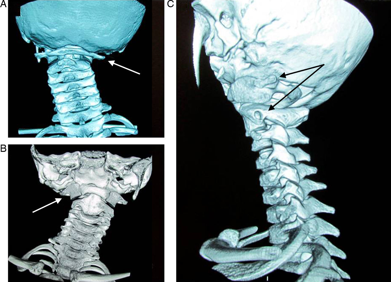 Grisel's Syndrome as a Sequela of a Complicated Acute Mastoiditis ...