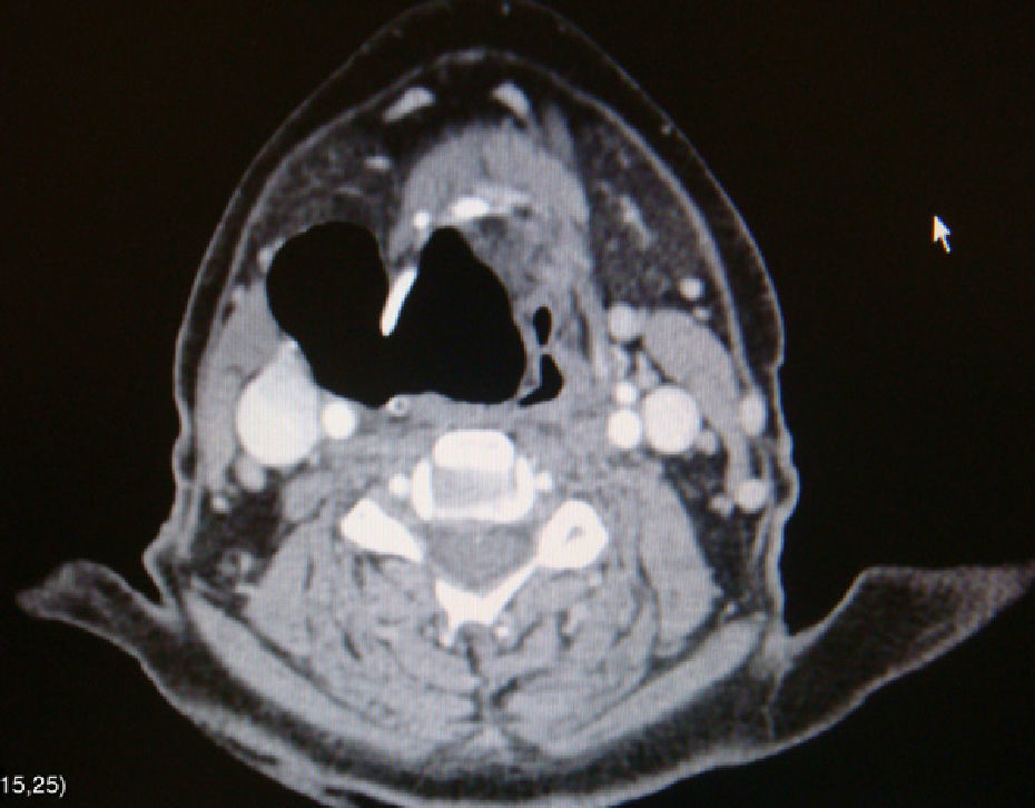 Pharyngocele | Acta Otorrinolaringológica Española