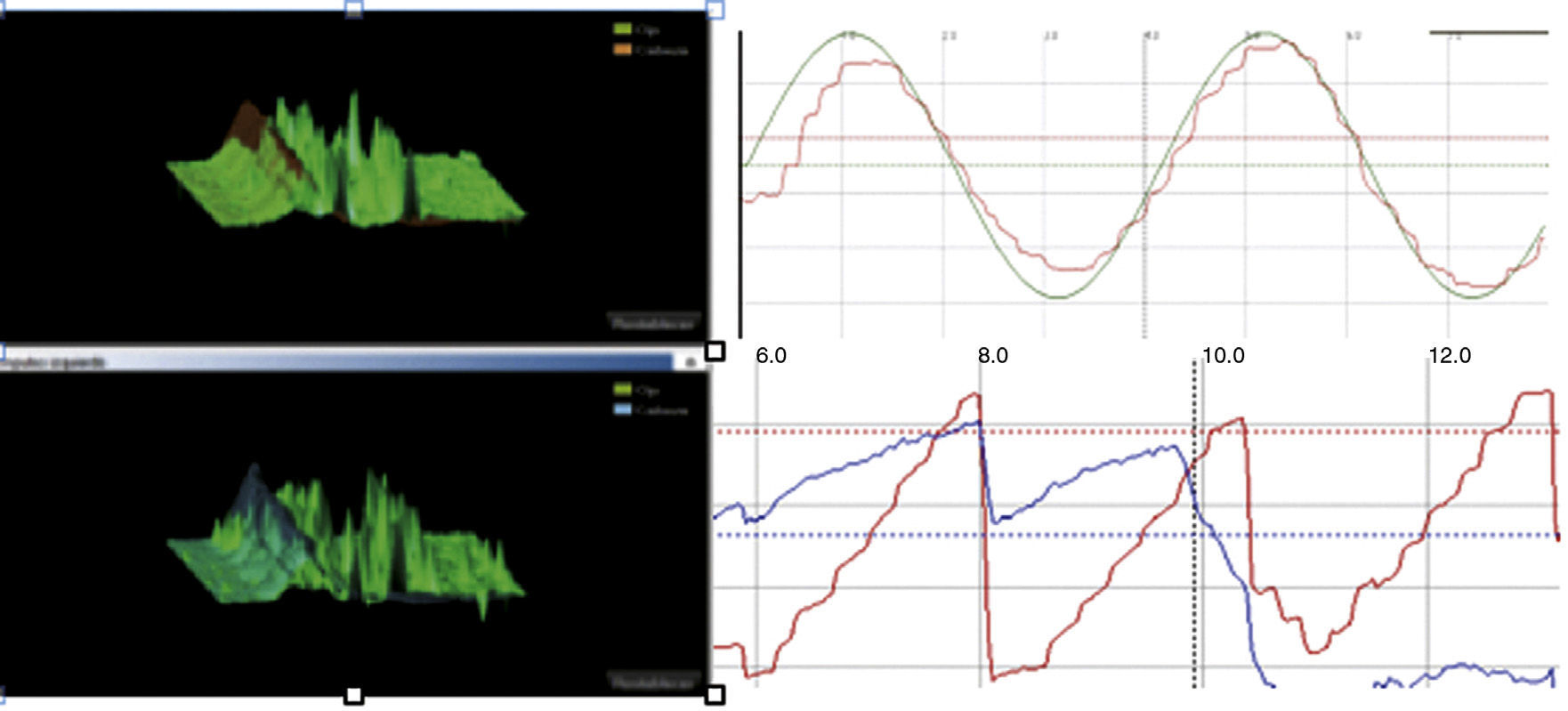Cerebellar Ataxia With Neuropathy and Bilateral Vestibular Areflexia ...