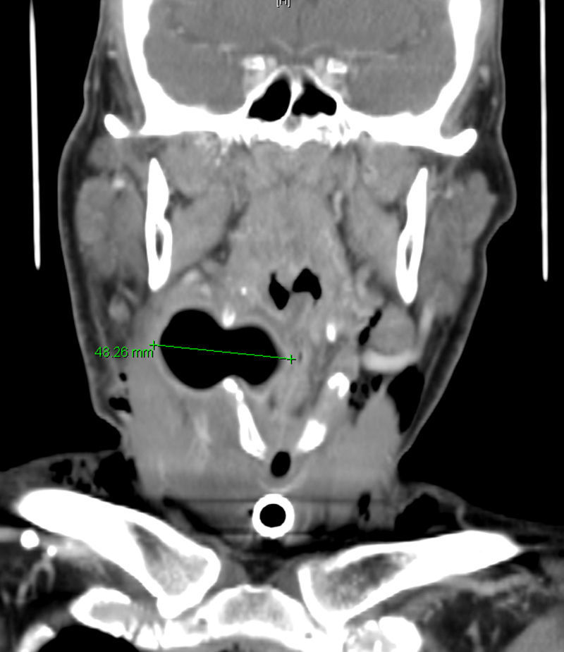 Pyolaryngocele: A Rare Cause of Acute Dyspnea | Acta ...